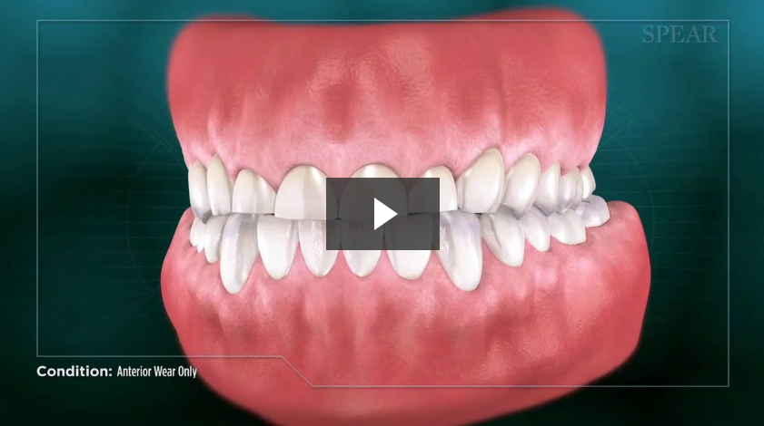 Anterior Wear Only - Westney