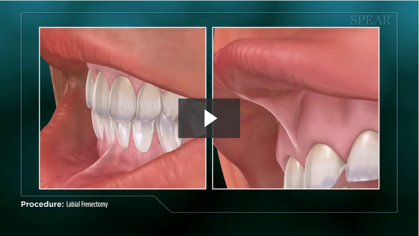 Labial Frenectomy - Westney