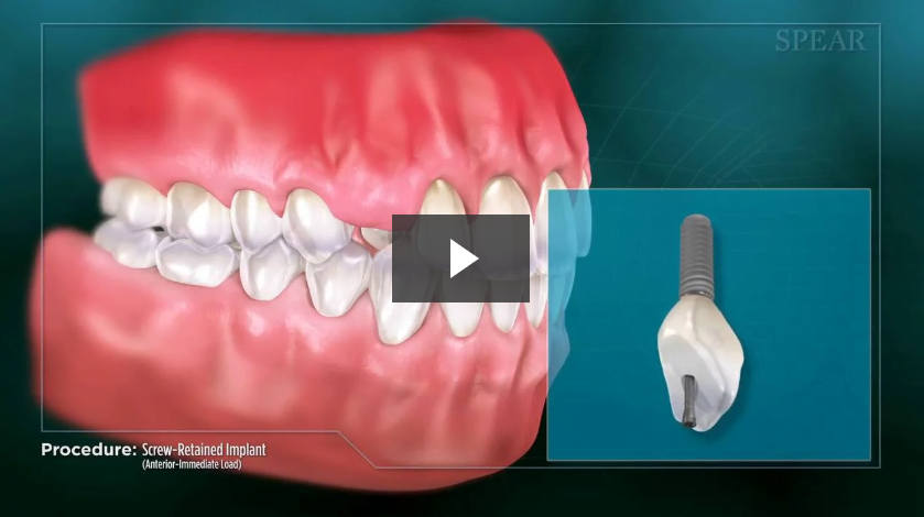 Screw-Retained Implant (Anterior- Immediate Load) - Westney