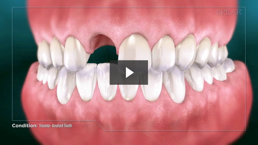 Trauma- Avulsed Tooth - Westney