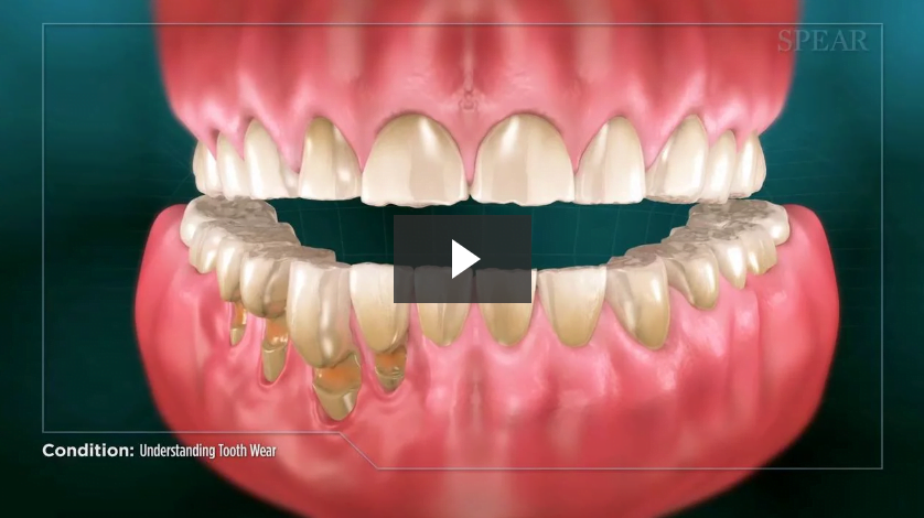 Understanding Tooth Wear - Westney